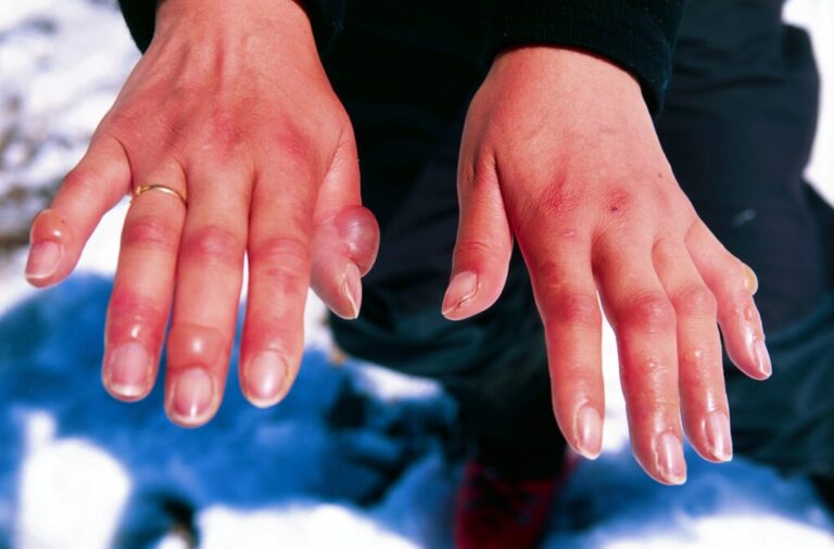 First Aid for Winter Hiking - How to Treat Frostbite, Hypothermia and ...